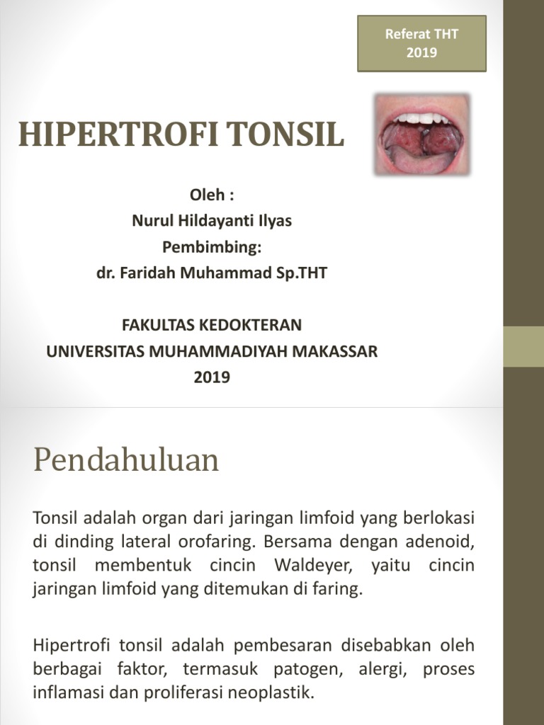 Hipertrofi Tonsil | PDF