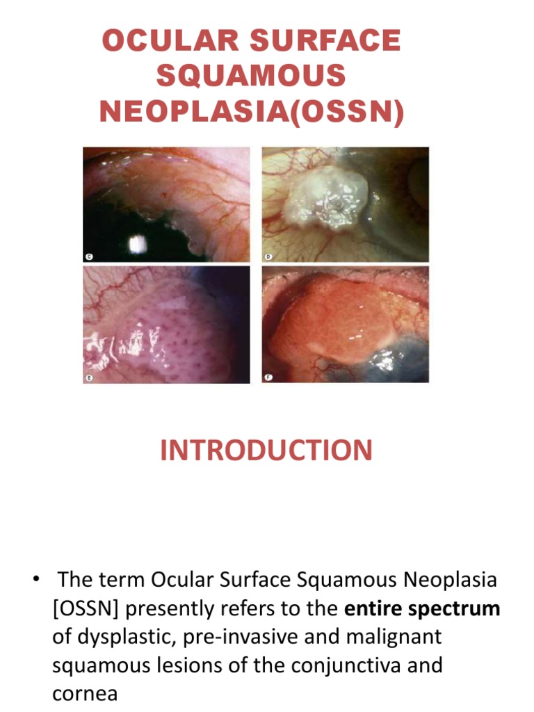 Ocular Surface Squamous Neoplasia (Ossn) | PDF | Interferon | Ultraviolet