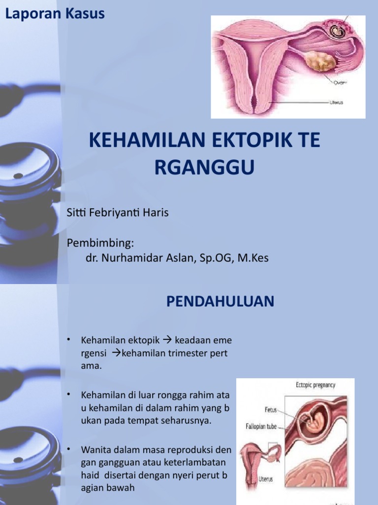 Kehamilan Ektopik Te Rganggu: Sitti Febriyanti Haris Pembimbing: Dr ...