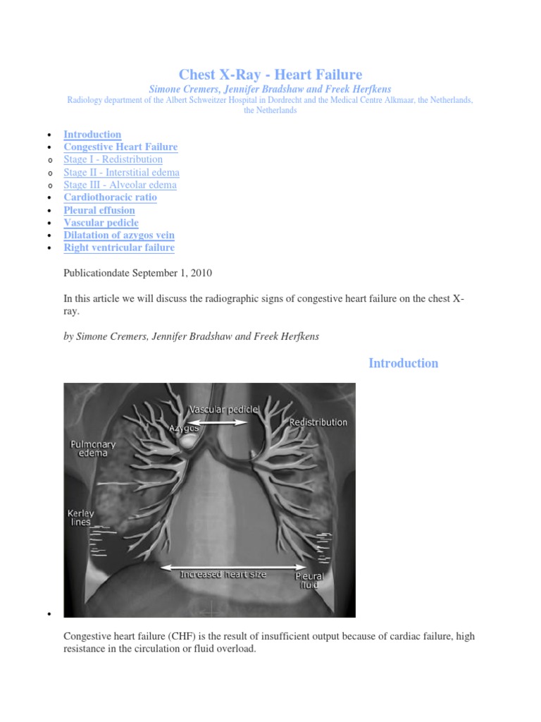 Chest X-Ray - Heart Failure | PDF | Heart Failure | Lung
