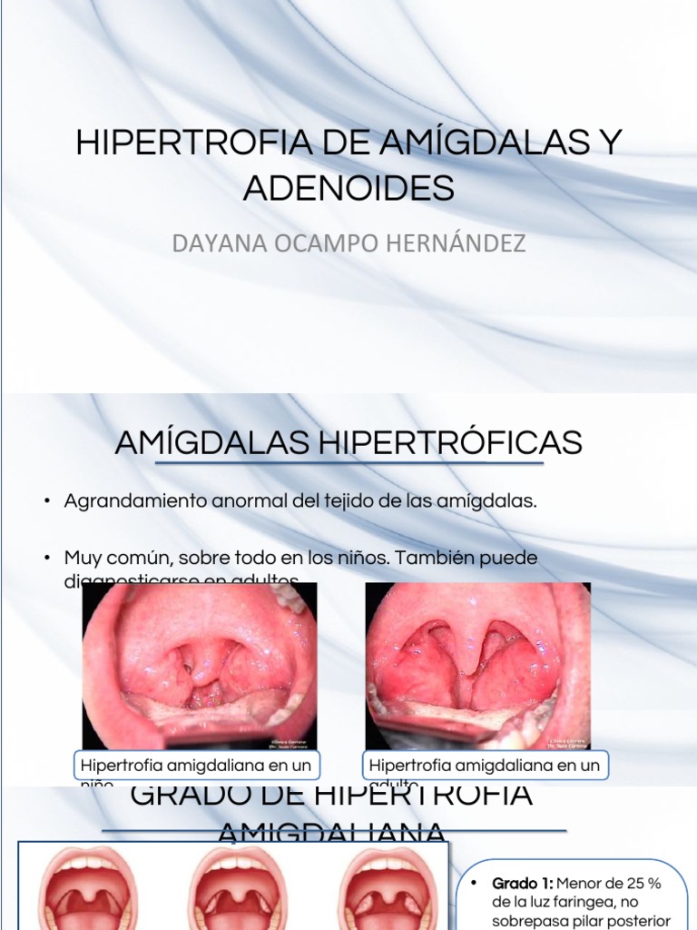 HIPERTROFIA DE AMÍGDALAS Y ADENOIDES.pdf | Enfermedades y trastornos ...