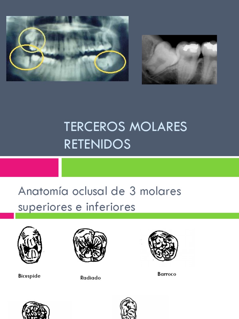 3 molares retenidos | Diente | Naturaleza