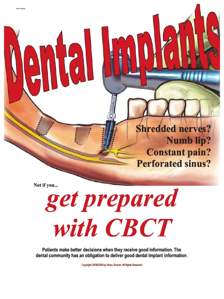 Dental Implants | PDF | Dental Implant | Dentistry
