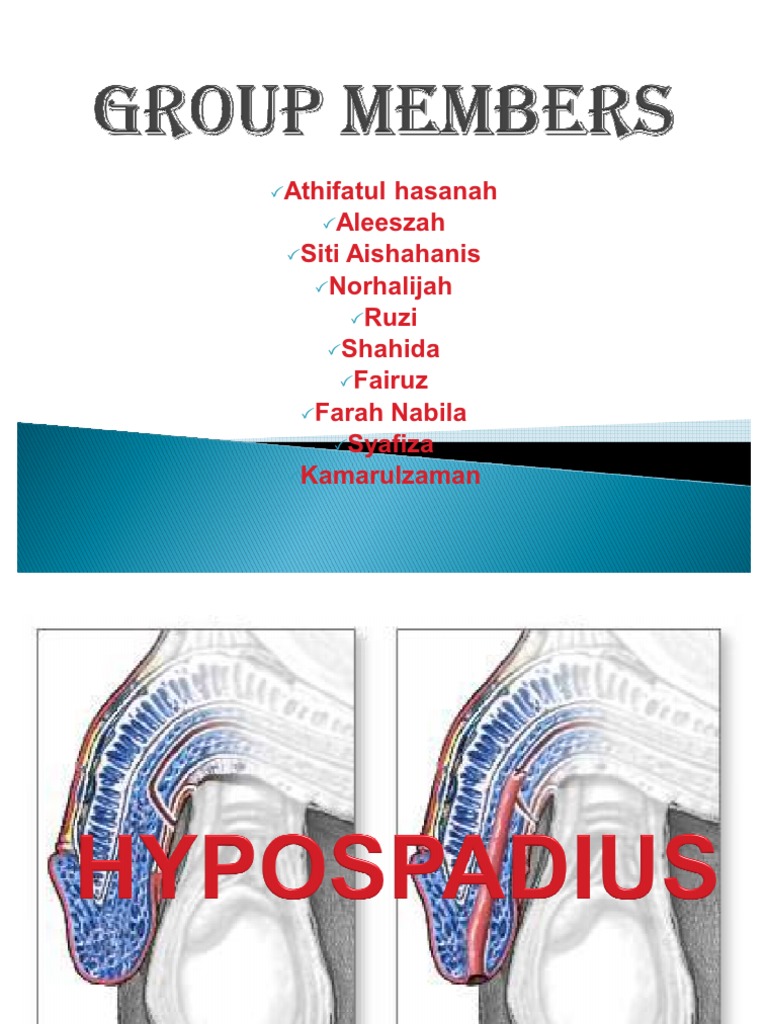 HYPOSPADIUS | PDF | Urinary Tract Infection | Surgery