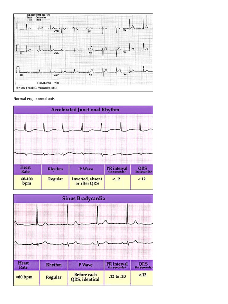 Normal Ecg.. Normal Axis | PDF | Artificial Cardiac Pacemaker ...