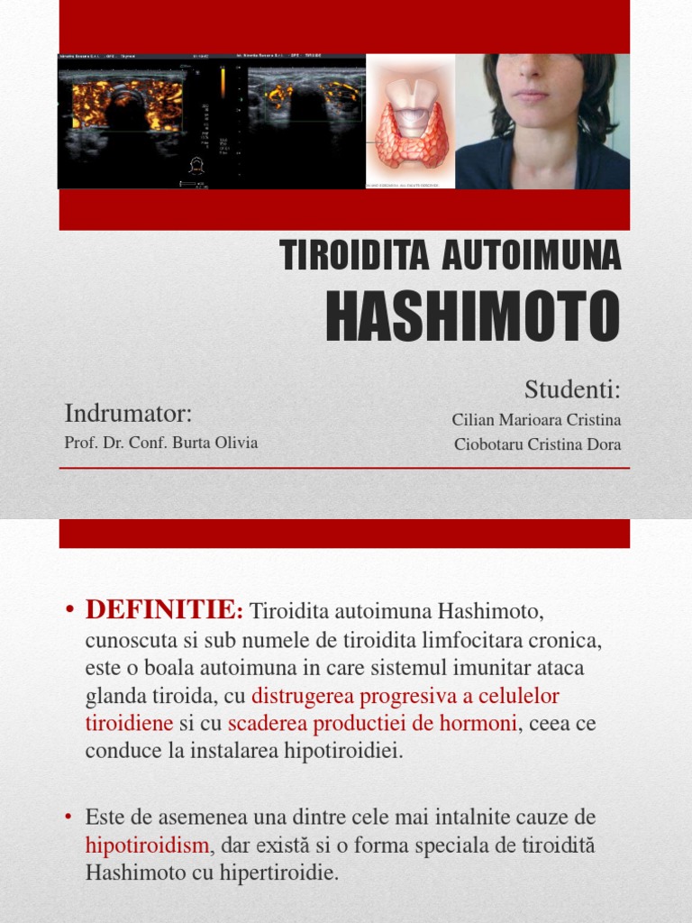 TIROIDITA AUTOIMUNA HASHIMOTO Cilian-Ciobotaru | PDF