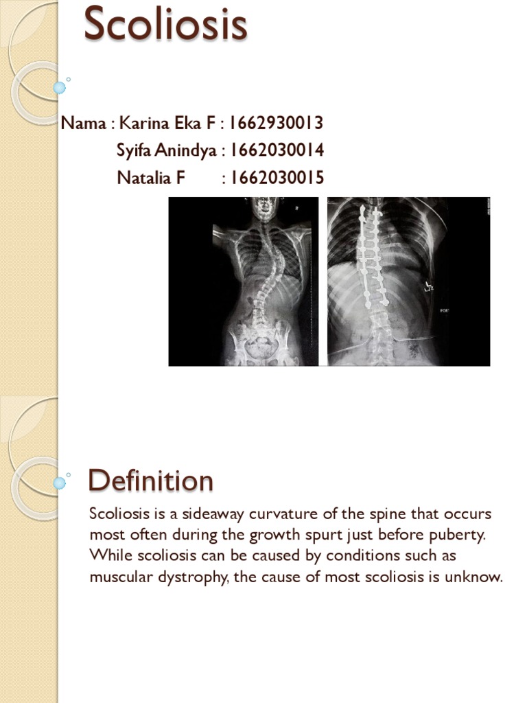 Scoliosis PPT B Ing | PDF | Scoliosis | Nervous System