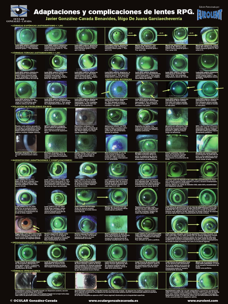 Tabla de Adaptacion de Lentes RGP | PDF | Tensioactivo | Ligero