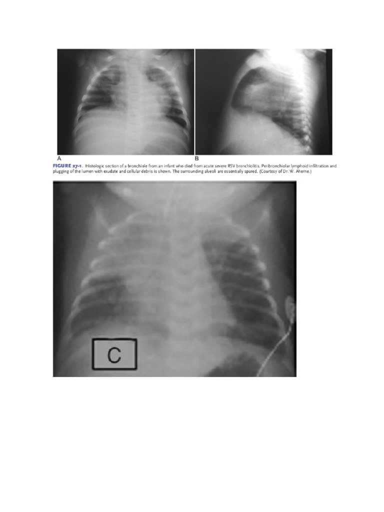 Radiologi Bronkiolitis | PDF