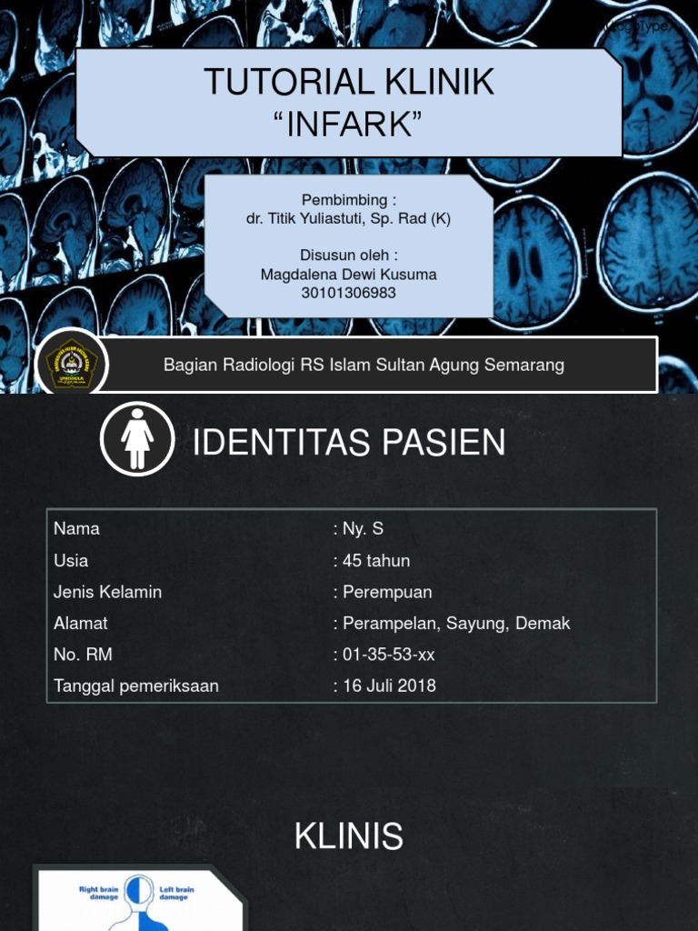 Tutorial Radiologi CT Scan Infark | PDF