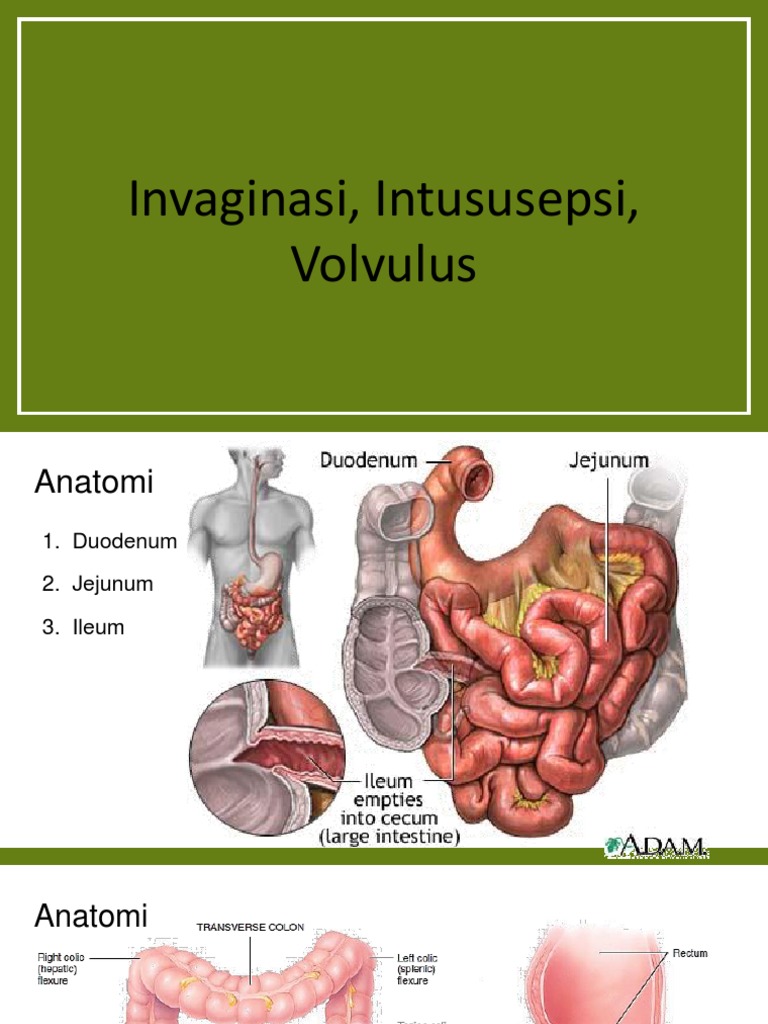 TL Intususepsi | PDF | Kesehatan Holistik | Sains & Matematika