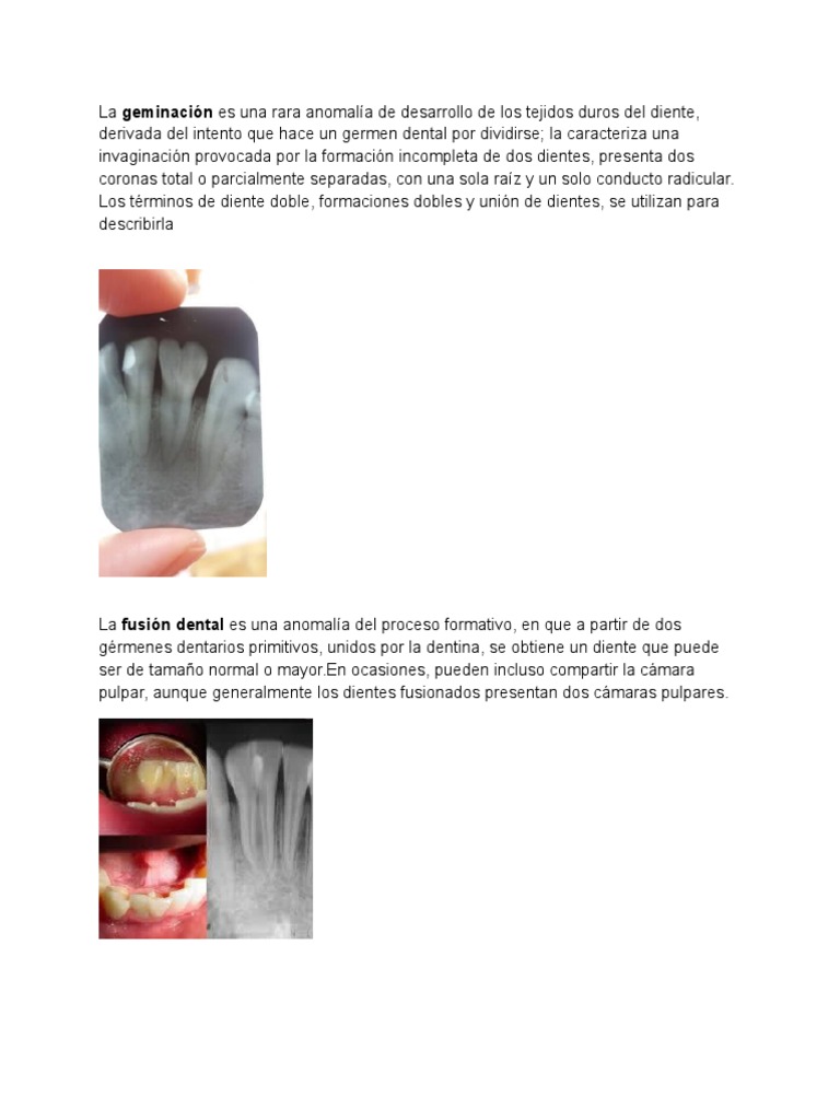 La Geminación | PDF | Diente | Medicina