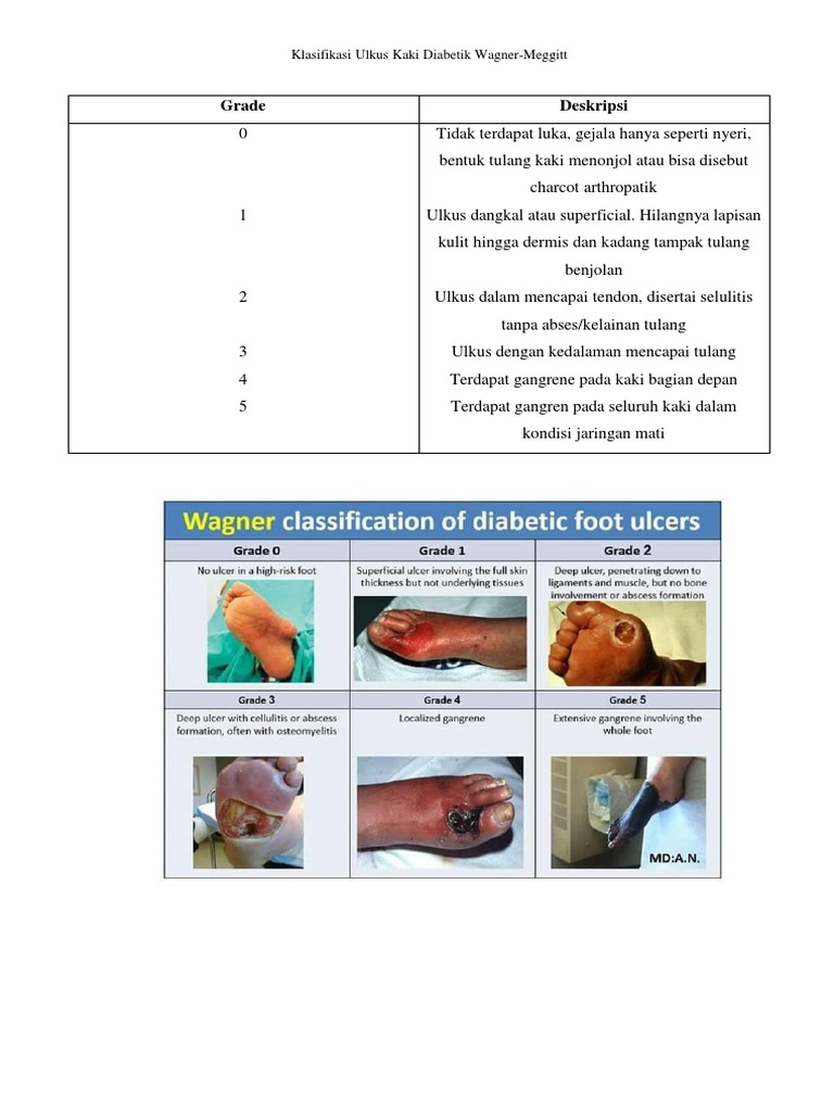 Klasifikasi Ulkus Kaki Diabetik Wagner | PDF