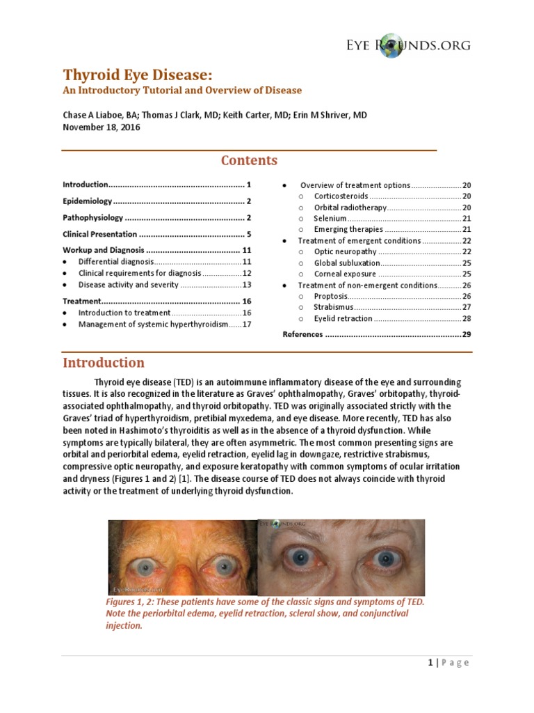 Thyroid Eye Disease PDF | PDF | Hyperthyroidism | Medical Specialties
