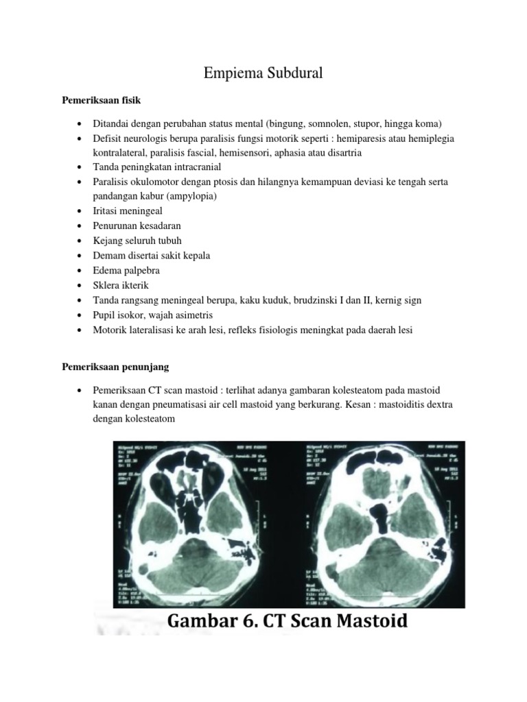 Empiema Subdural | PDF