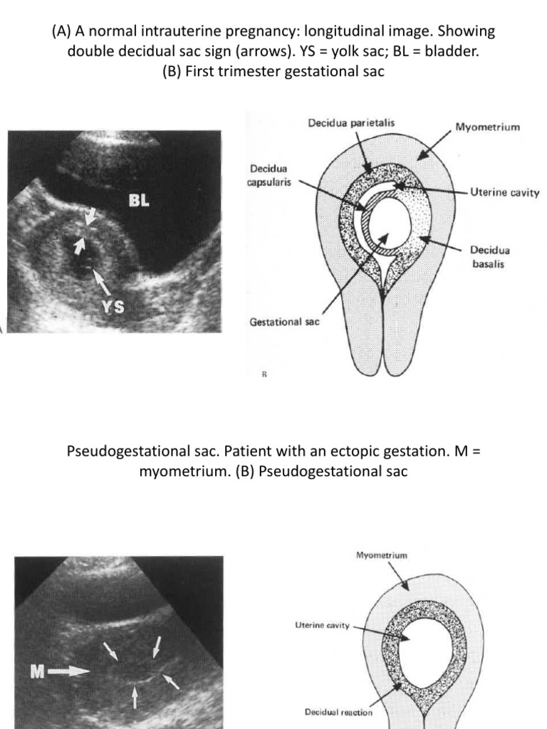 Obsgyn | PDF | Ovarian Cancer | Uterus