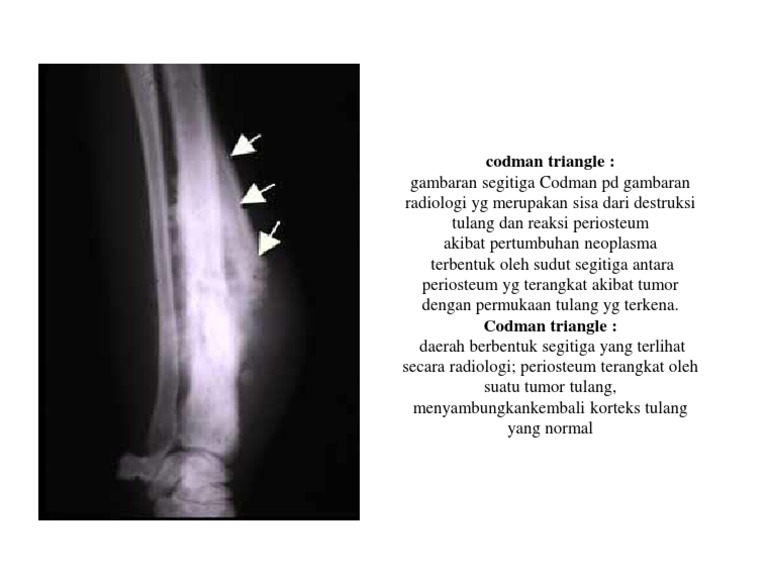 Codman Triangle | PDF