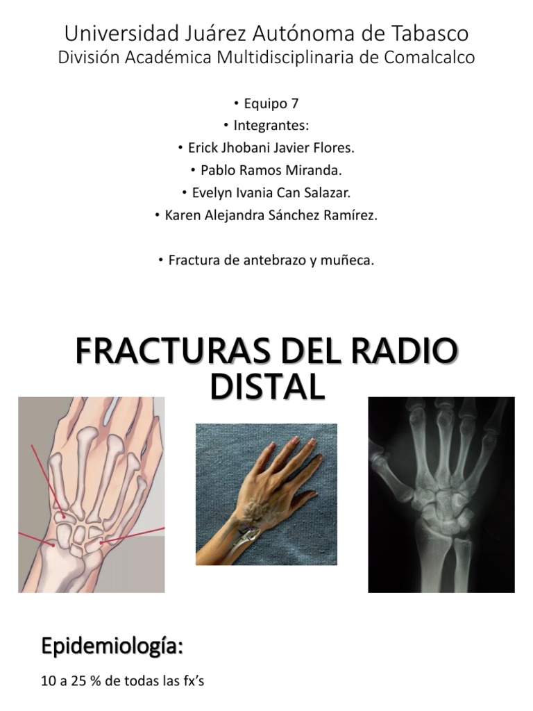 FX de Radio Distal | PDF | Mano | Anatomía humana
