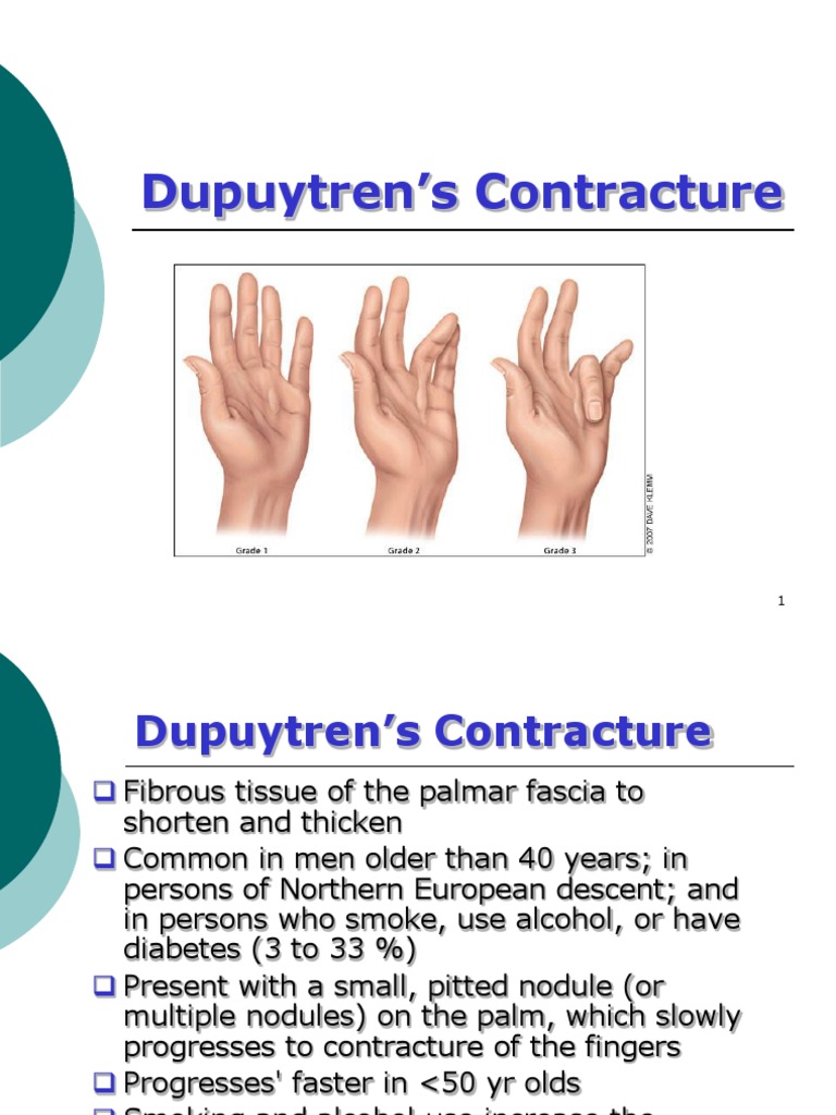 2 Dupuytrens Contracture | Fibromyalgia | Chronic Fatigue Syndrome