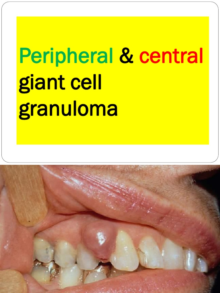 Peripheral Central Giant Cell Granuloma NXPowerLite | PDF | Bone ...