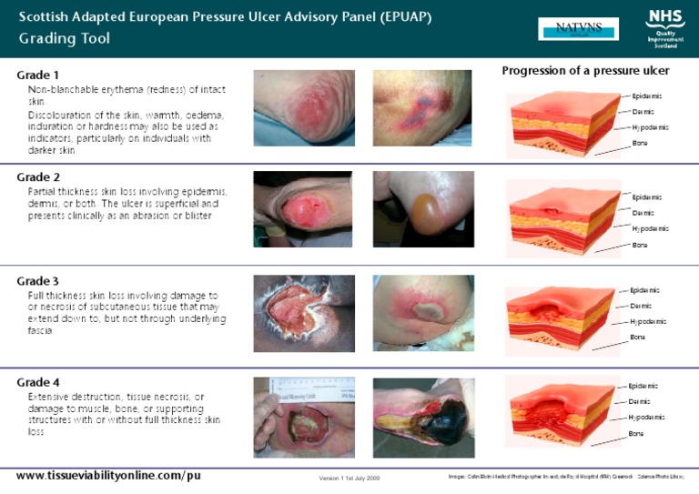 EPUAP Pressure Ulcer Grading Tool | PDF | Skin | Endocrine System