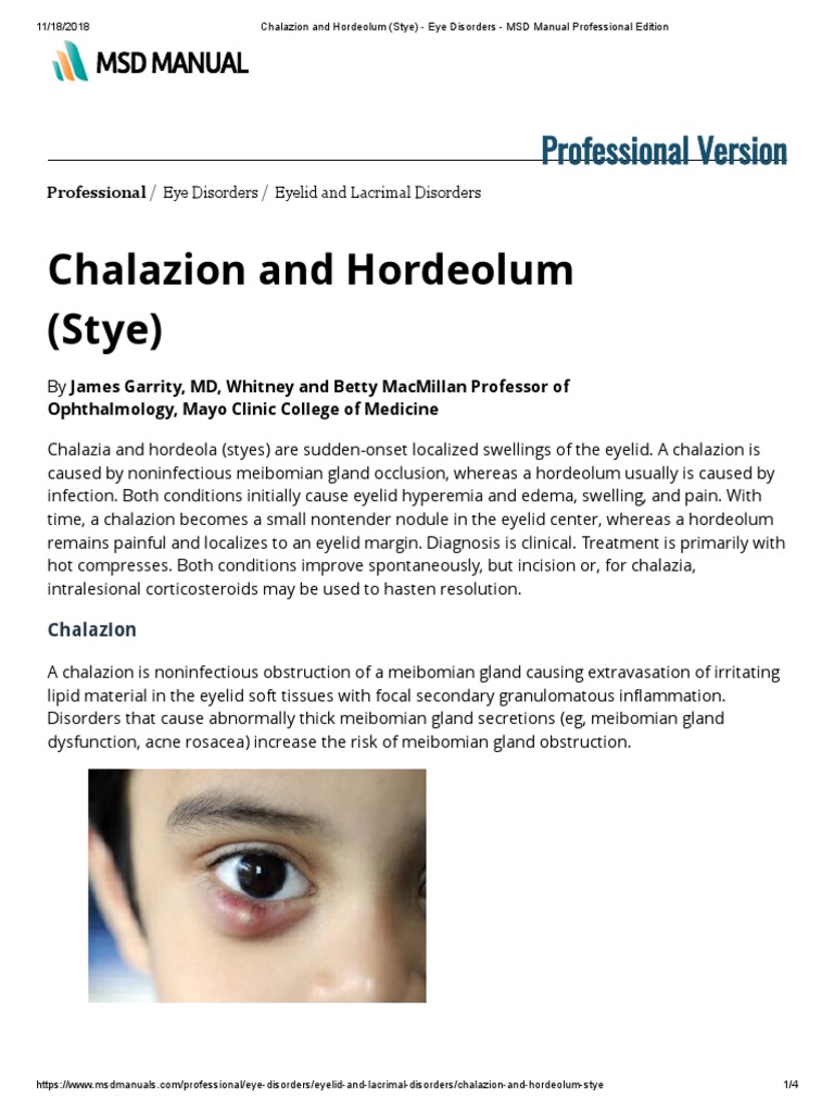 Chalazion and Hordeolum (Stye) - Eye Disorders - MSD Manual ...