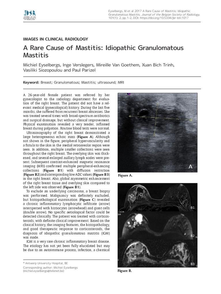 A Rare Cause of Mastitis: Idiopathic Granulomatous Mastitis | PDF ...