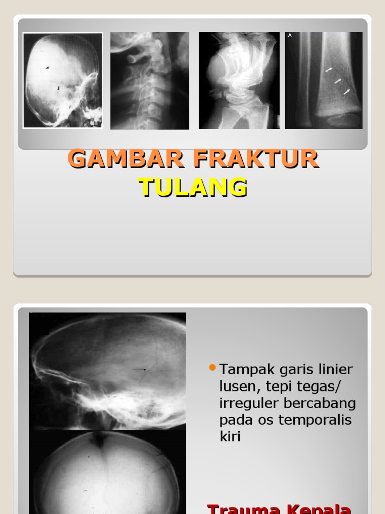Jenis dan Ciri Fraktur pada Tulang | PDF