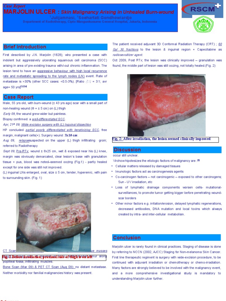 Marjolin Ulcer POSTER (RSCM) | Radiation Therapy | Carcinogenesis
