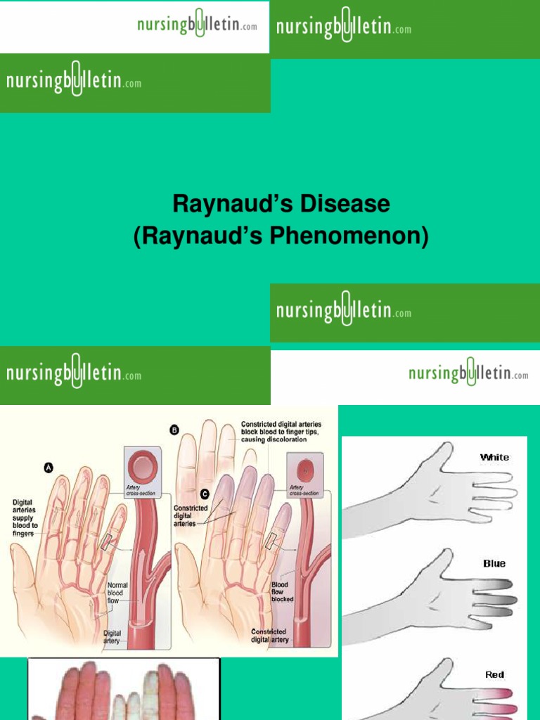 Raynaud 'S Disease (Raynaud 'S Phenomenon) | PDF | Angiology | Medical ...