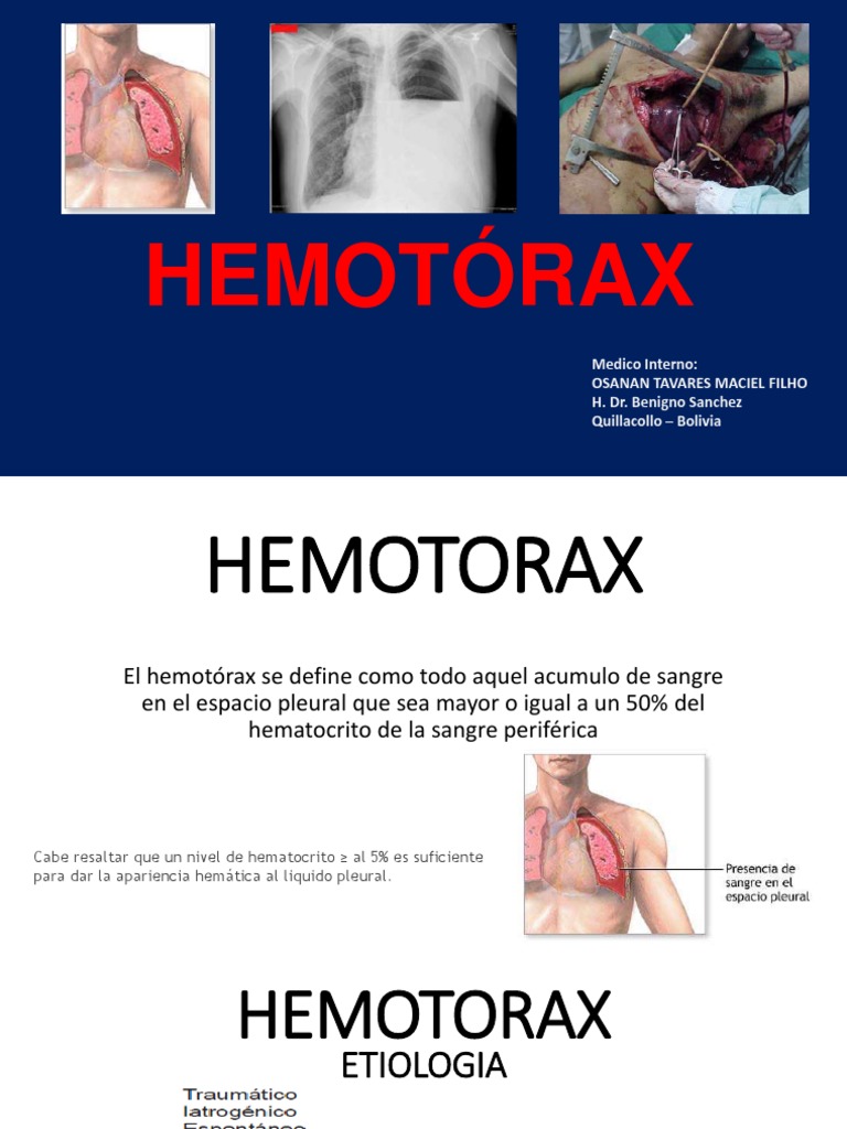 Hemotorax | PDF | Especialidades Medicas | Medicina CLINICA