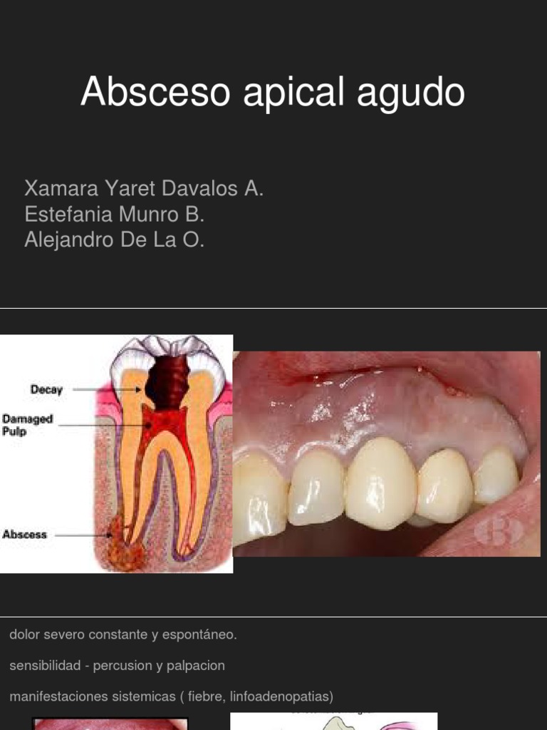 Absceso Apical Agudo | PDF