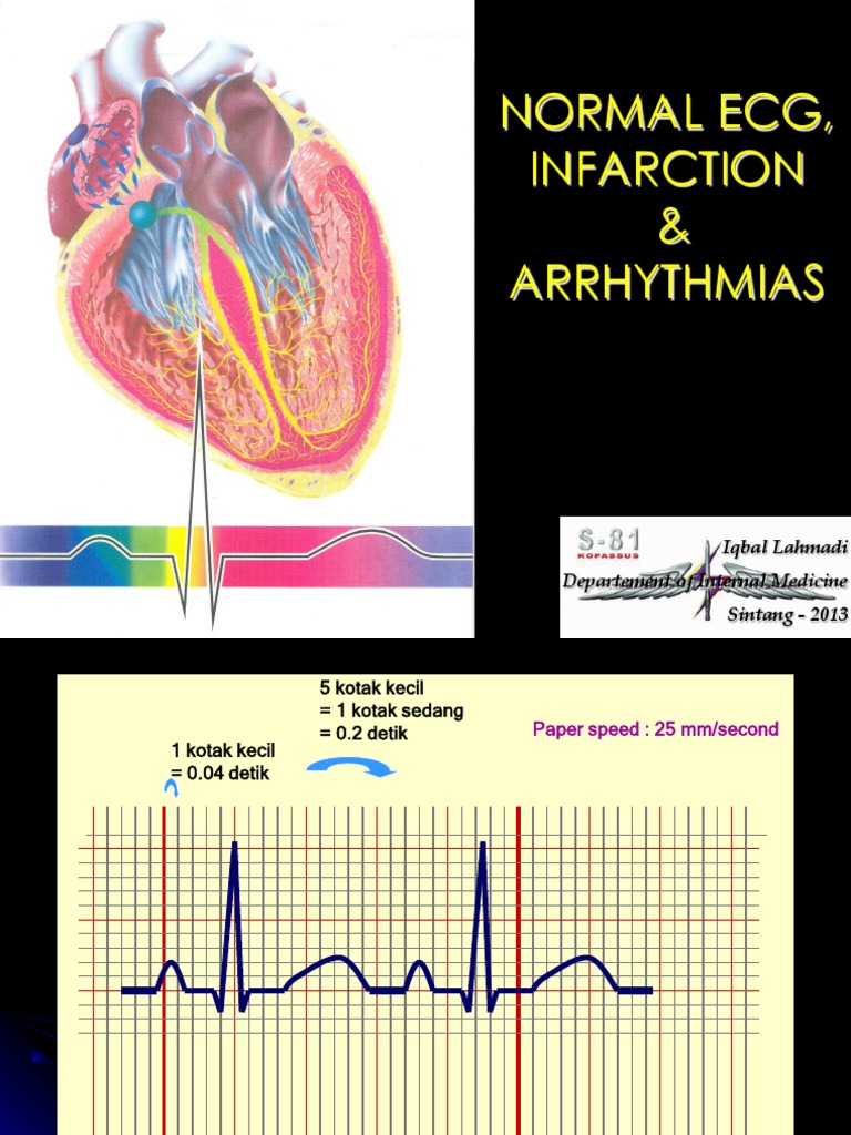 Normal Ecg, Infarction & Arrhythmias: Iqbal Lahmadi Departement of ...