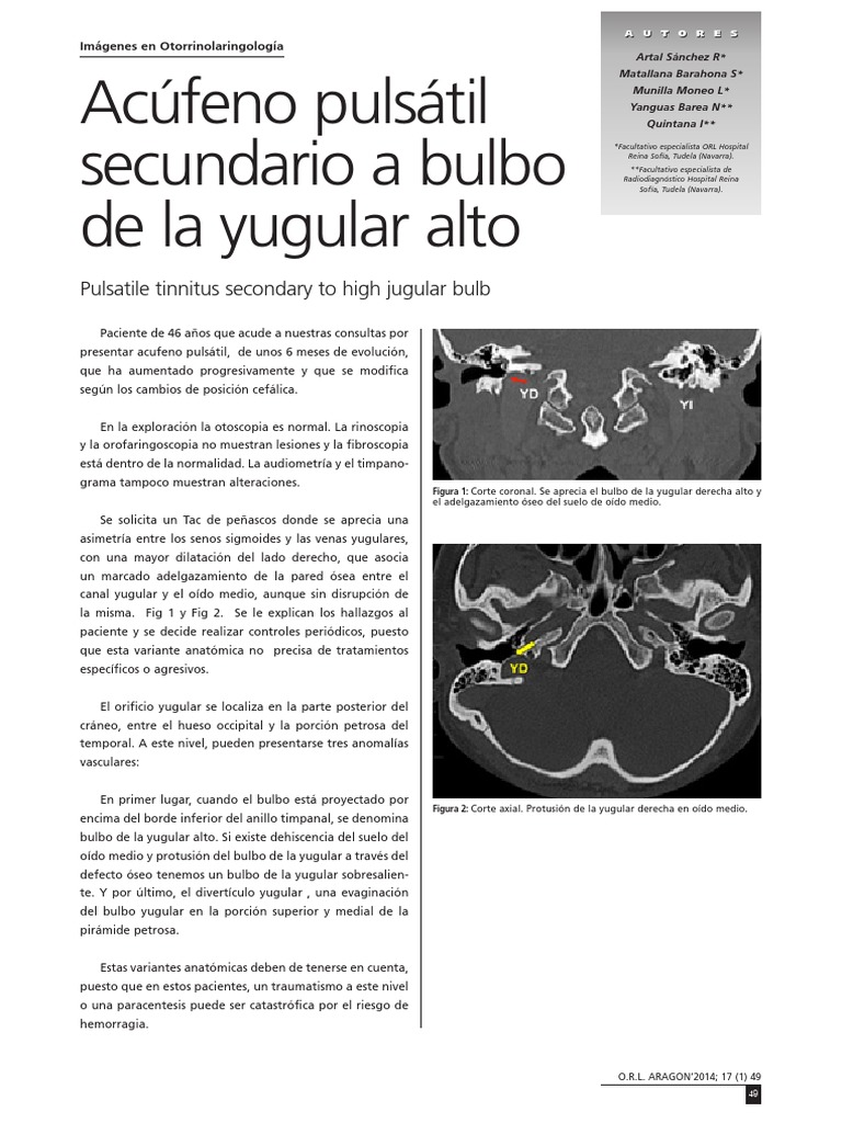 Acúfeno Pulsátil por Bulbo Yugular Alto | PDF | Tinnitus ...