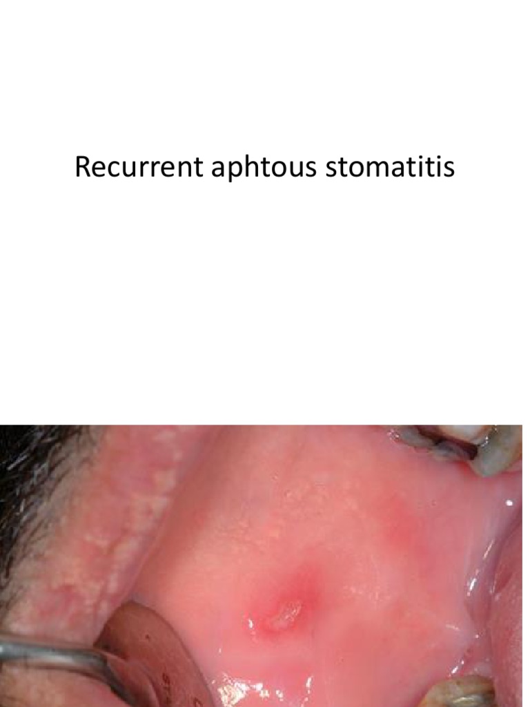 Recurrent Aphtous Stomatitis | PDF