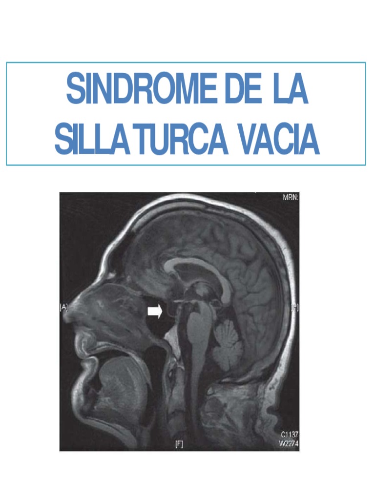 Síndrome de la Silla Turca Vacía | PDF | Hormona | Sistema endocrino