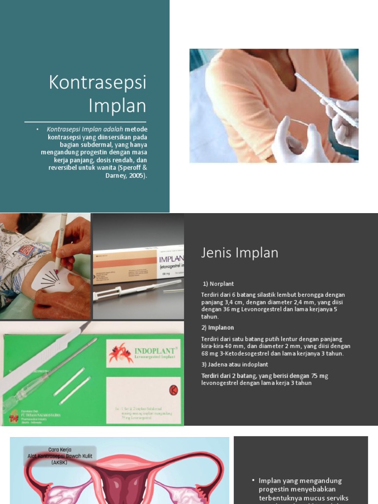 in Konvensional Implant | PDF