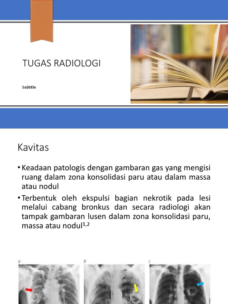 PR Radiologi TB | PDF