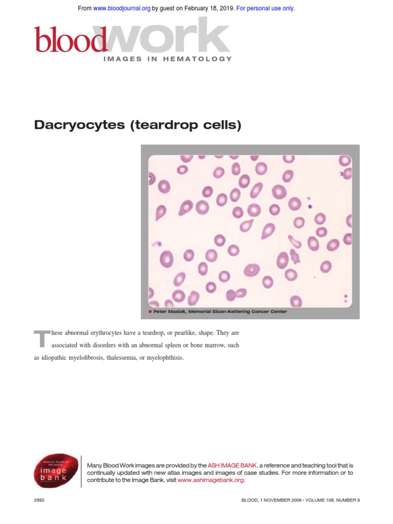 Blood: Dacryocytes (Teardrop Cells) | PDF