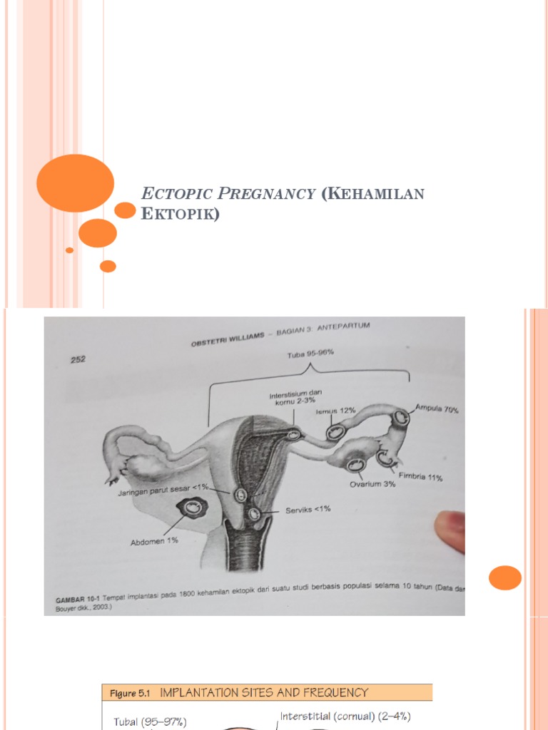 Ectopic Pregnancy | PDF | Uterus | Human Reproduction