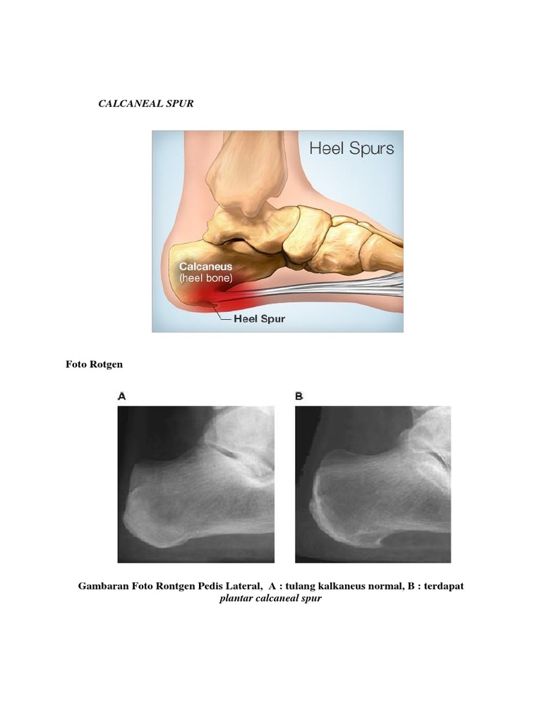 Gambar Calcaneal Spur | PDF