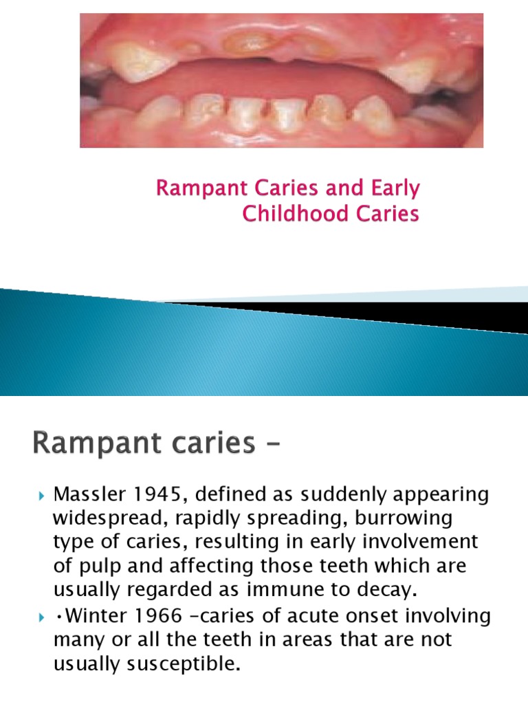 Ecc and Rampant Caries | PDF | Human Tooth | Oral Hygiene