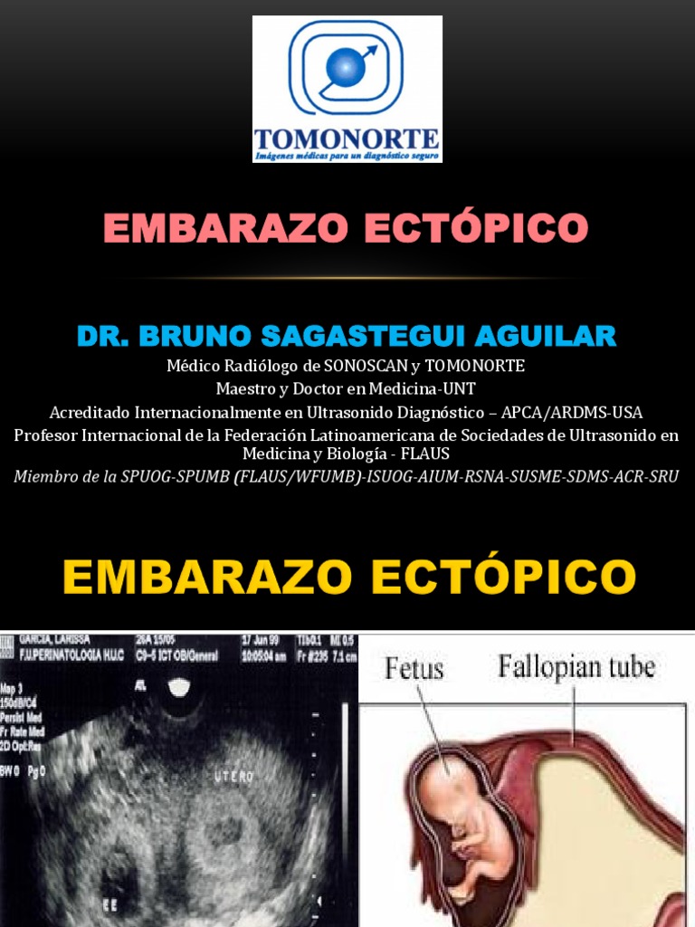 3 - Embarazo Ectopico PDF | PDF | El embarazo | Enfermedades y trastornos