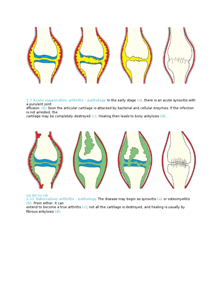 2.7 Acute Suppurative Arthritis - Pathology (A) (B) (C) (D) | PDF