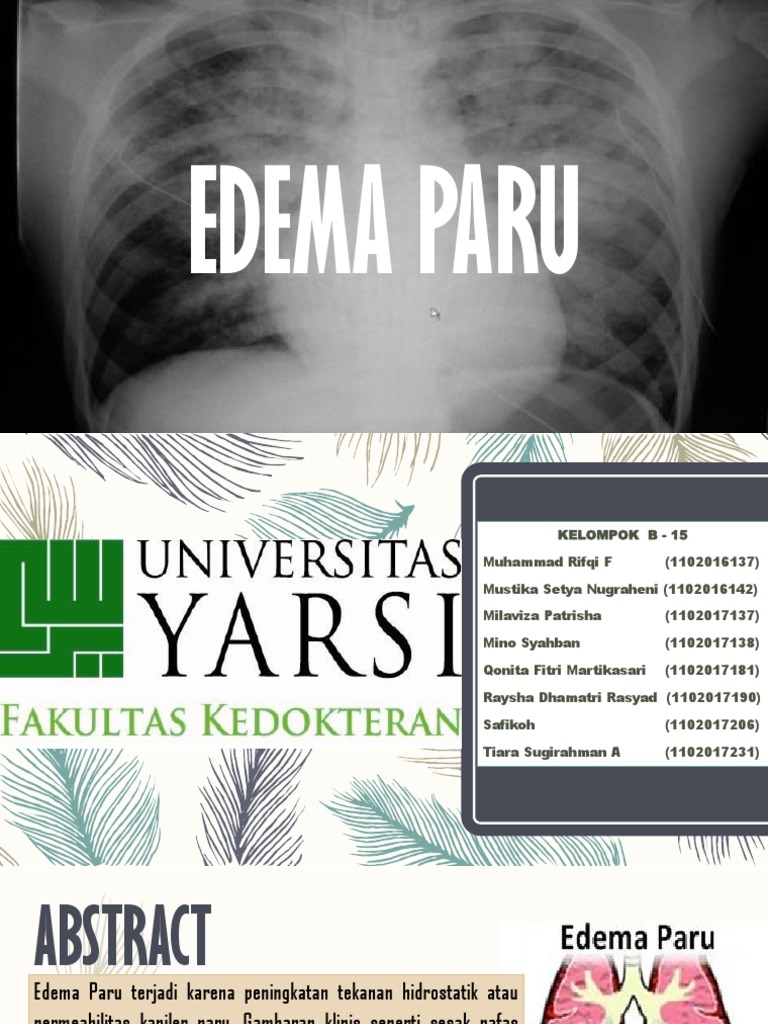 Edema Paru | PDF