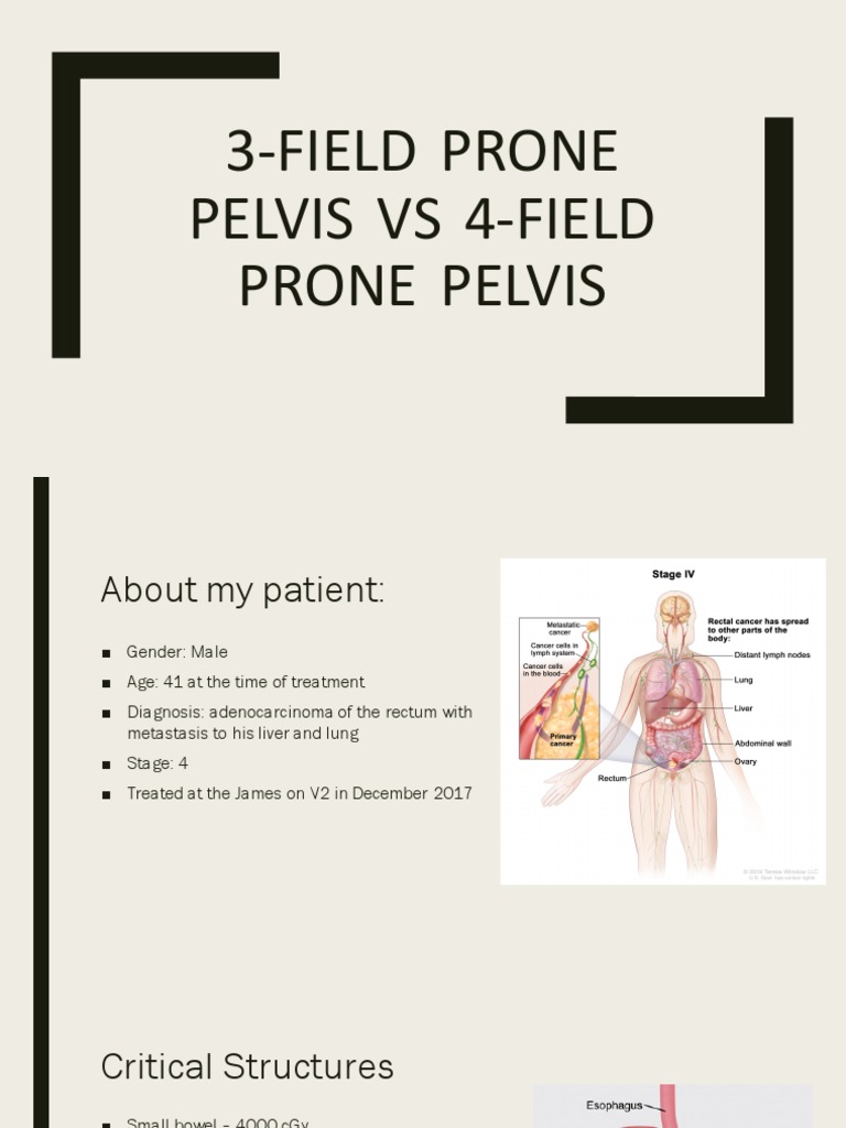 3-Field vs 4-Field Prone Pelvis Treatment | PDF | Neoplasms | Diseases ...