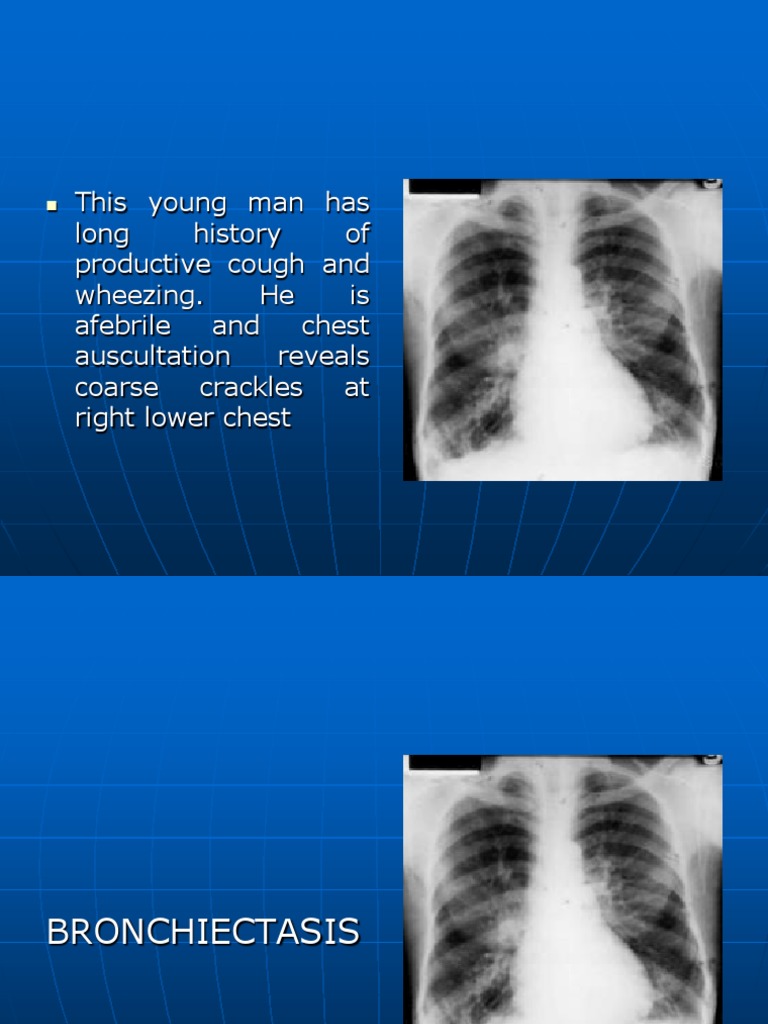 This Young Man Has Long History of Productive Cough and Wheezing. He Is ...