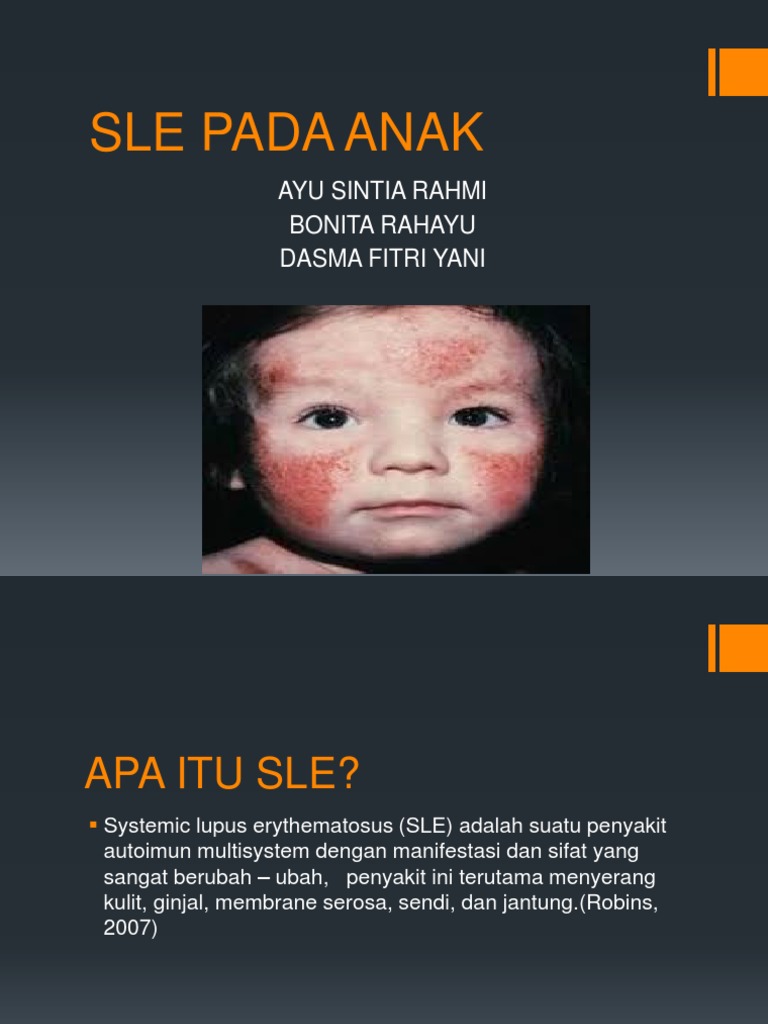 Sle Pada Anak | PDF