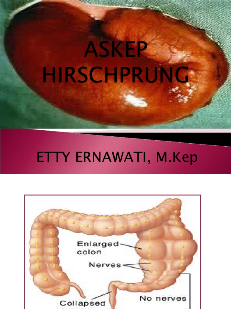 Panduan Penyakit Hirschsprung | PDF | Sains & Matematika