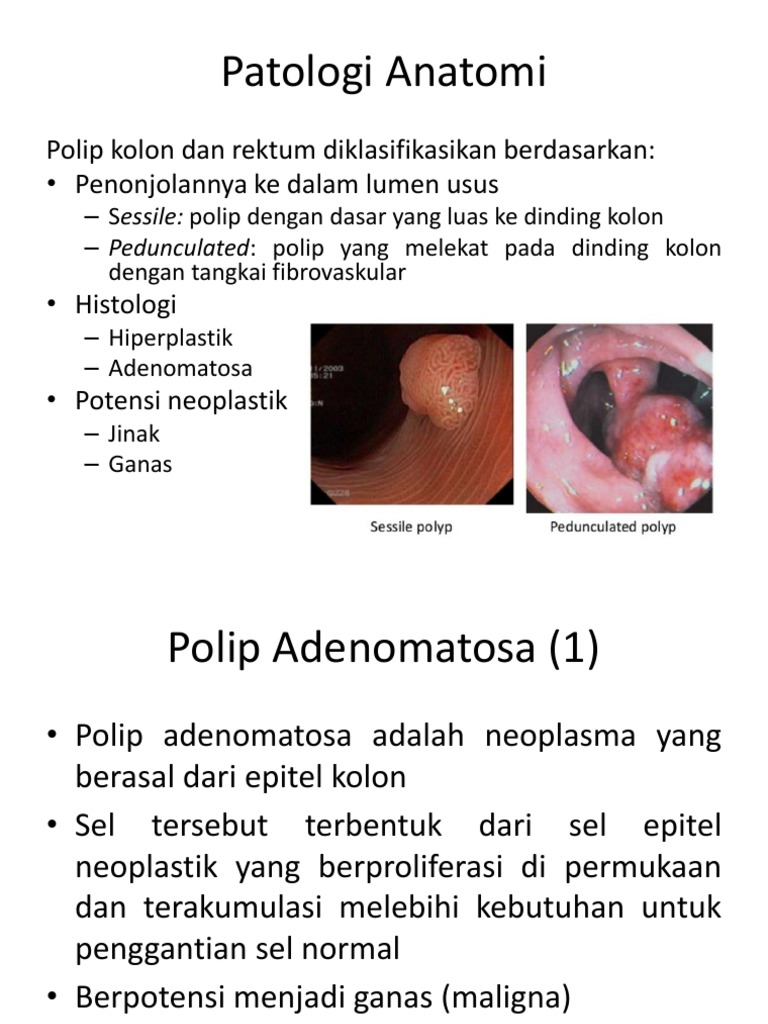Patologi Anatomi Polip Kolon Dan Rektum | PDF